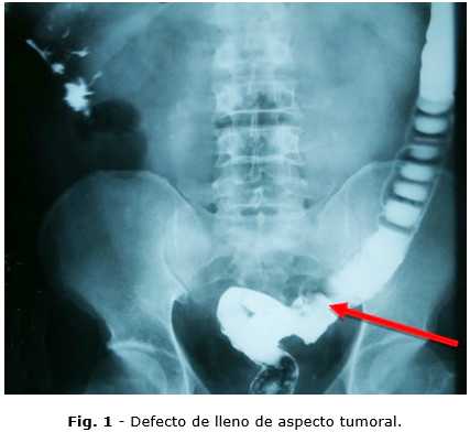 Pseudotumor de colon sigmoide | Pérez Assef | Revista Cubana de Medicina